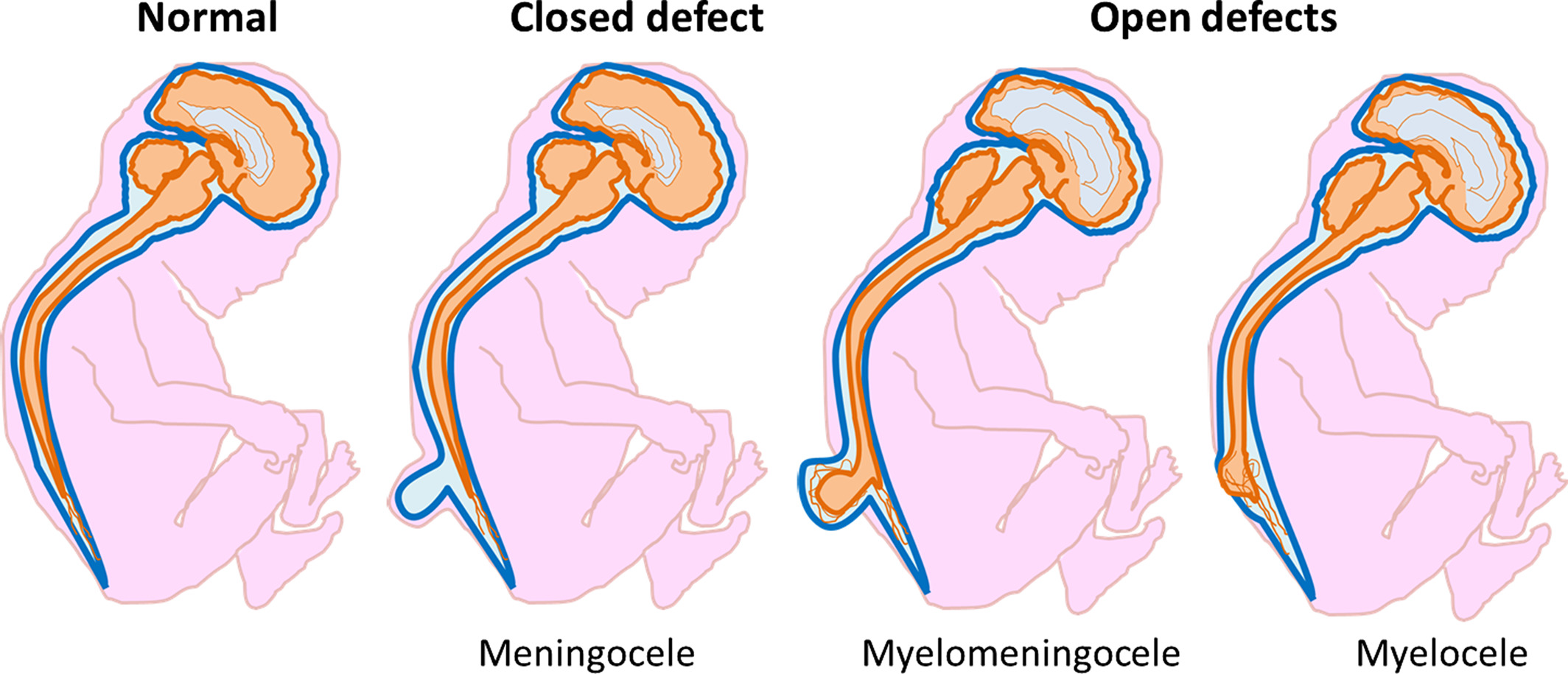 Possible New Therapies for Deadly Neural Tube Defects! - Charged Magazine